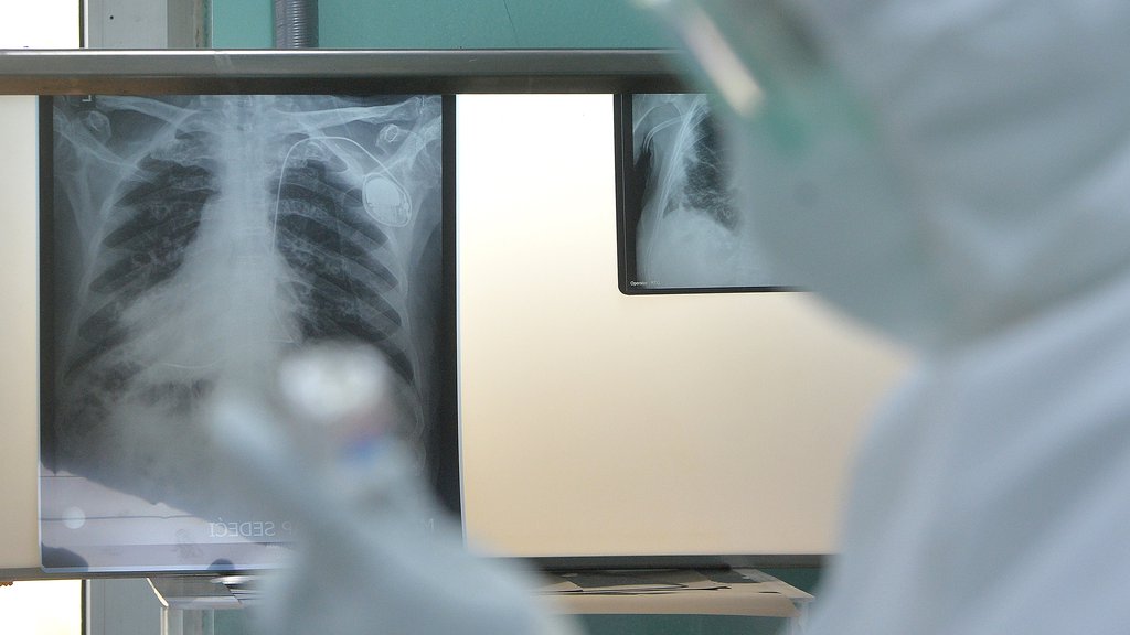 RANO OTKRIVANJE OPAKE BOLESTI VAŽNO: Evo kada počinje skrining za otkrivanje raka pluća u ...