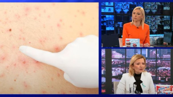 'PAO JE KOLEKTIVNI IMUNITET, VIRUS MORBILA JE SADA PRISUTAN U ...