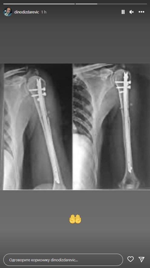 OPERISAN BIVŠI ZADRUGAR! Cela ruka mu u gipsu, ima čak dva ŠRAFA i TRPI ...
