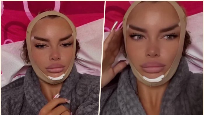 Cela glava joj u zavojima: Bivša zadrugarka imala operacije na licu ...