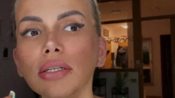 BOMBA! Ermina Pašović skinula zavoje i pokazala ispeglano lice, za ...