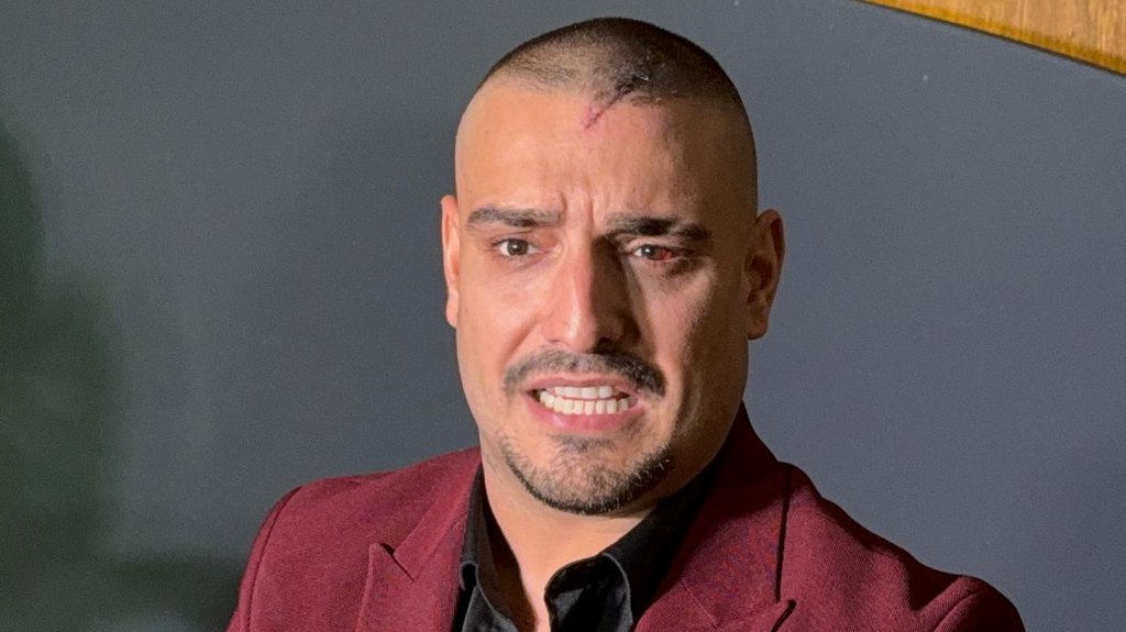 KRVAVO OKO I POSEKOTINA NASRED GLAVE! Prvi intervju Darka Lazića posle ...