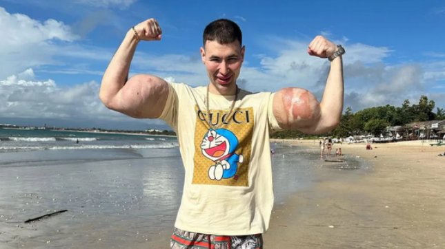 (UZNEMIRUJUĆE) POZNATOM INFLUENSERU PRETI AMPUTACIJA RUKU! Godinama ...